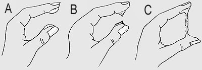 Biotube: Muco Cervical Incompetente
