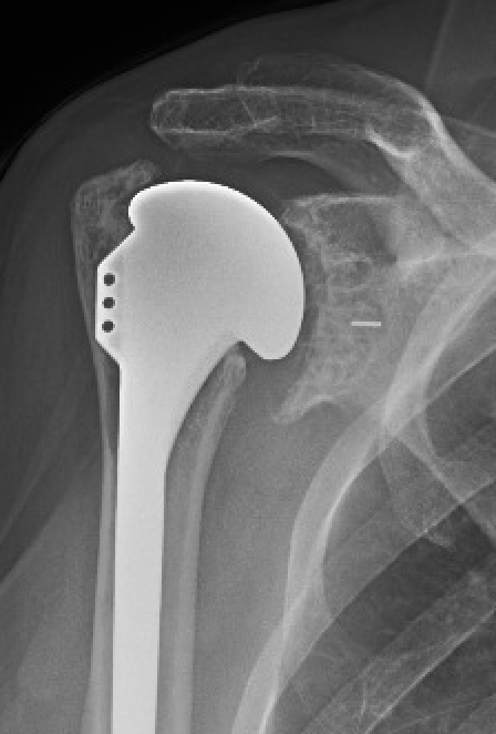 UW Shoulder and Elbow Academy: Postoperative infections of the shoulder ...