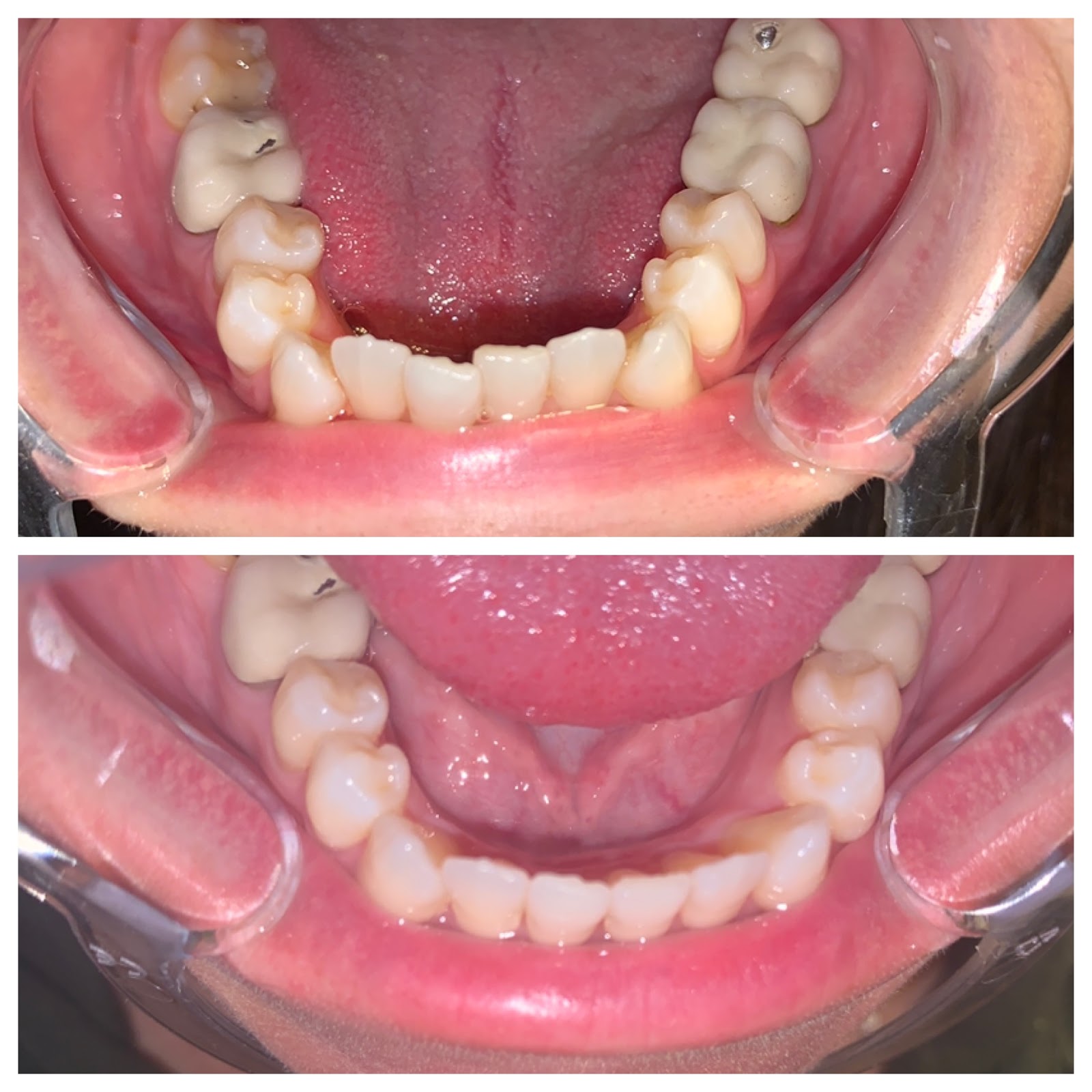 Pura Vida - Our Family Blog: unconventional teeth straightening