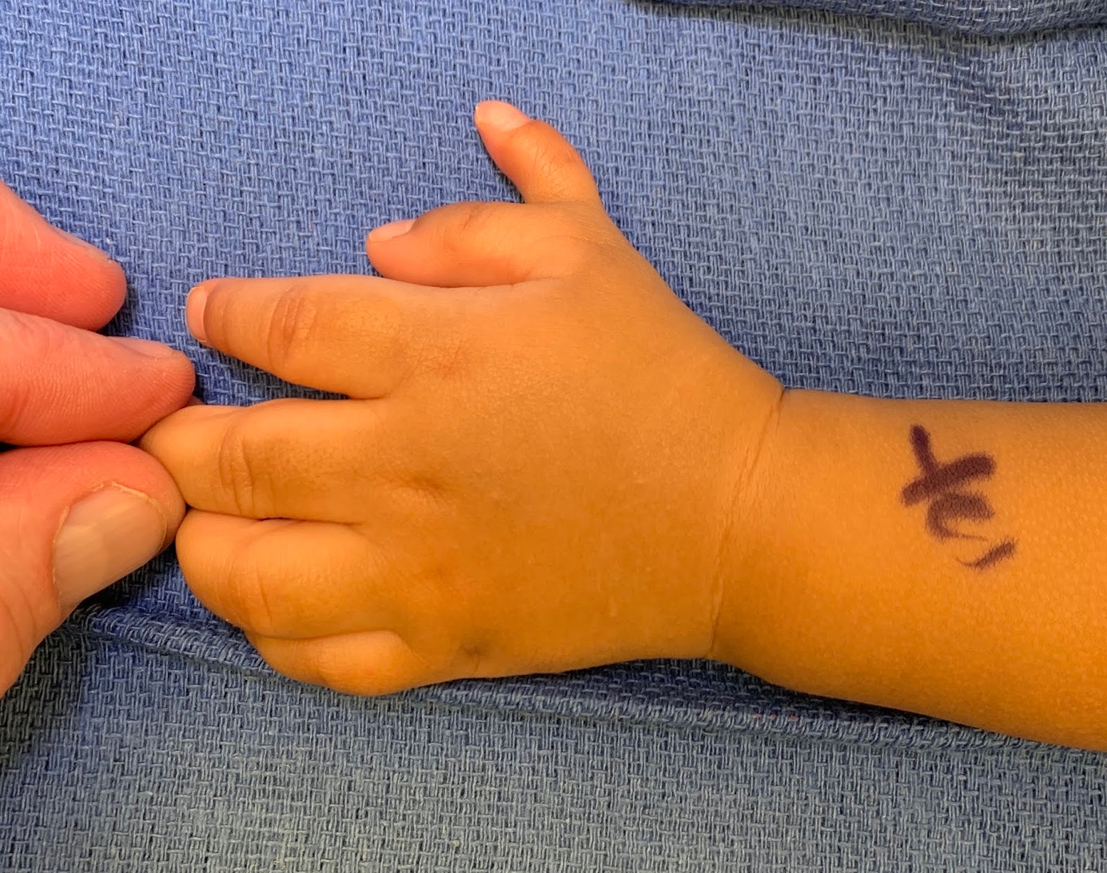 Two different thumb birth differences | Congenital Hand and Arm ...