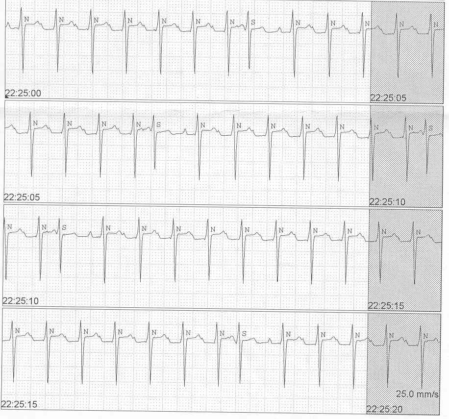 Pedi cardiology: EKG: PR interval