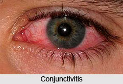 Indian Encyclopedia: Conjunctivitis