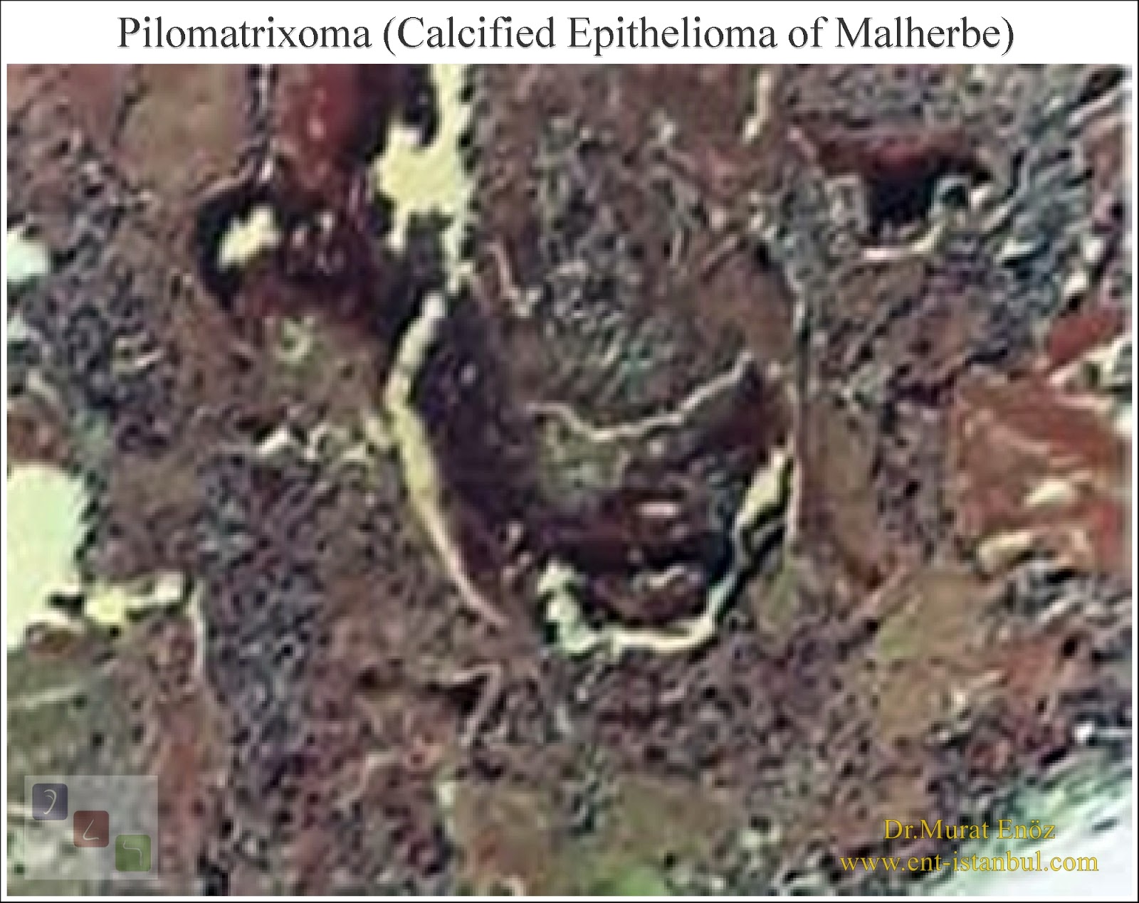 Pilomatrixoma on Left Eyebrow