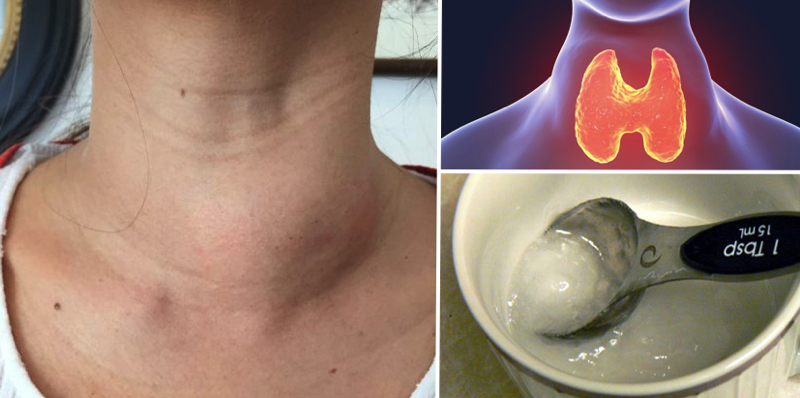 Sintomas Ng May Goiter Sa Loob Ng Lalamunan