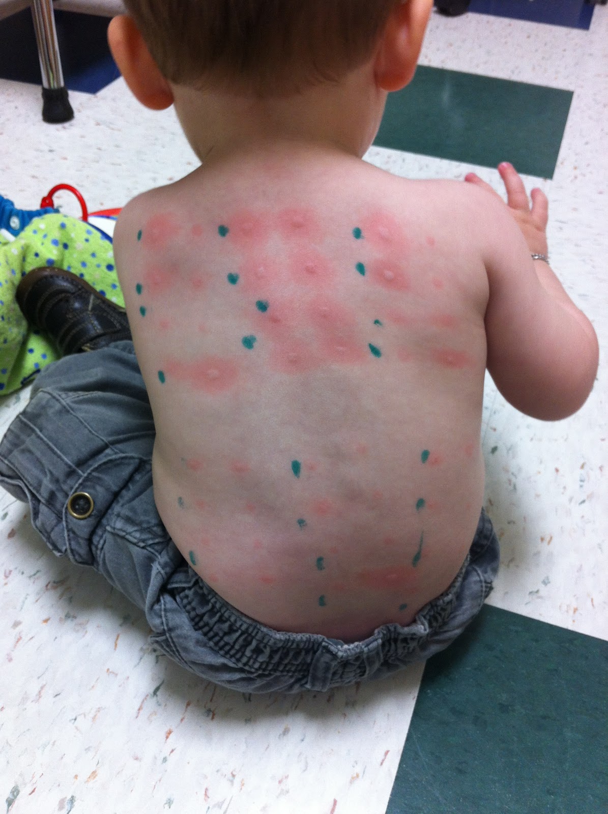 Aidan... With Eos: Update: April 11th - Allergy