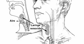 Asociación Barcelonesa de Laringectomizados: Cuidados tras una ...