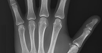 Penerapan Fisika Modern Untuk Materi Sinar-X