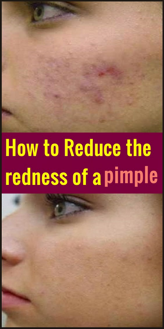 How to Reduce the redness of a pimple - beauty4everything3