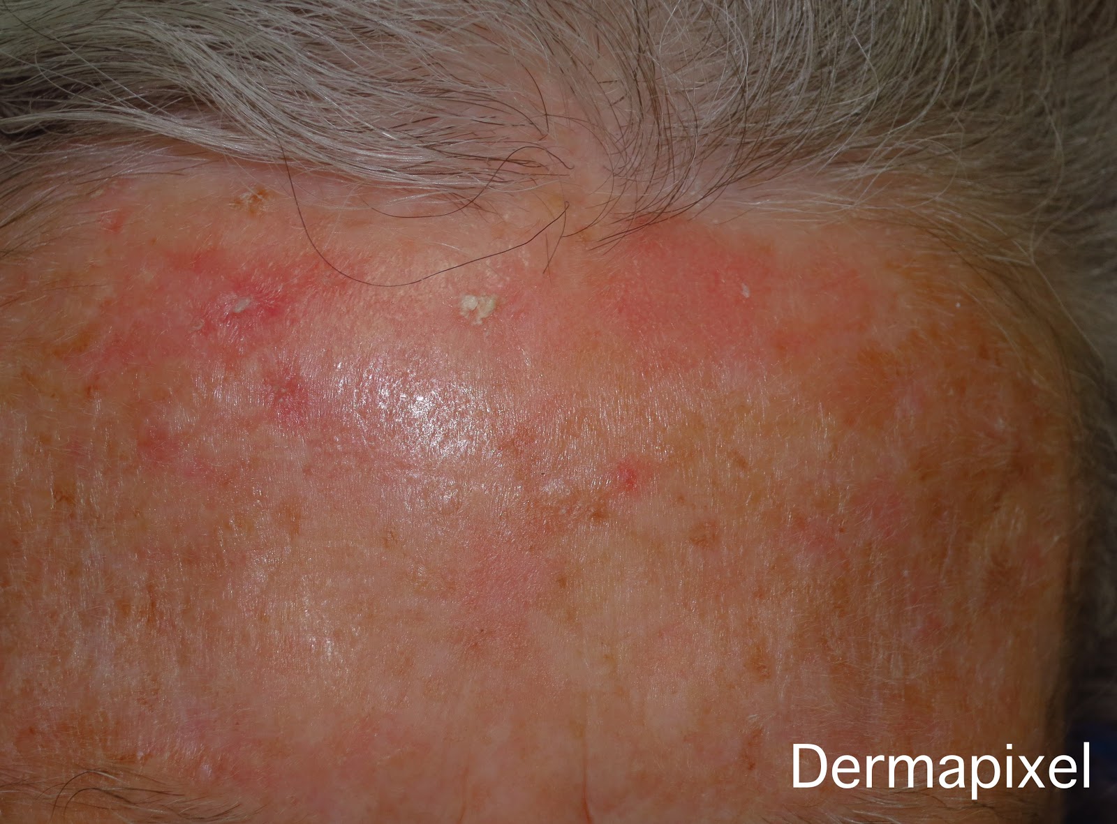 Dermapixel: junio 2019