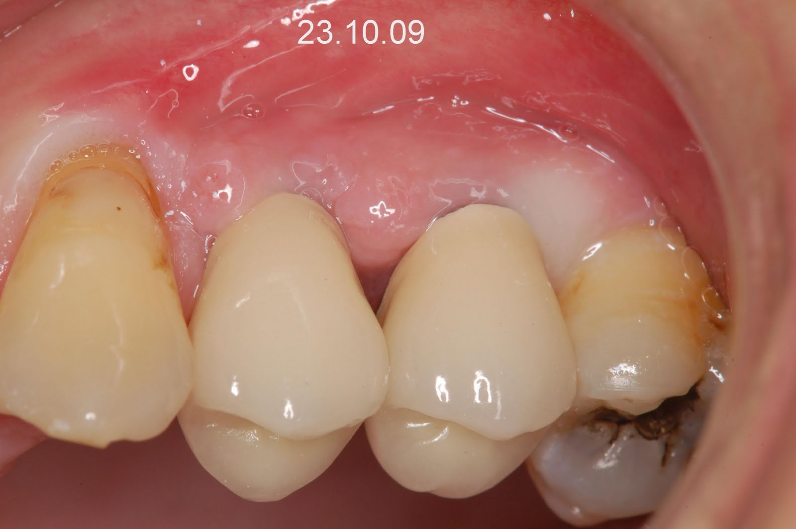 Docteur J.M. STROUMZA: PROFIL D’EMERGENCE : CLEF DE PERENITE IMPLANTAIRE