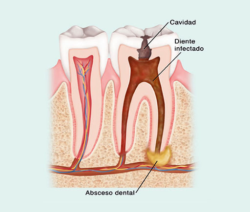 ¿Qué es un absceso dental? ¿Es peligroso? - OdontoVida