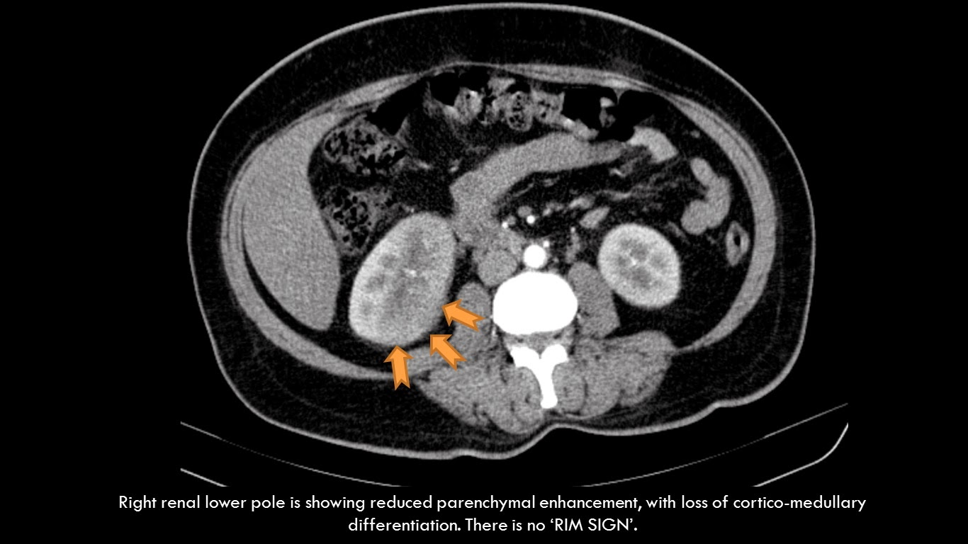 Ultimate Radiology : CASE OF BILATERAL PYELONEPHRITIS