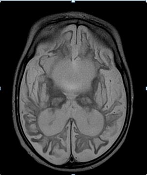 pediatric neurology: The consequence of a reversal sign
