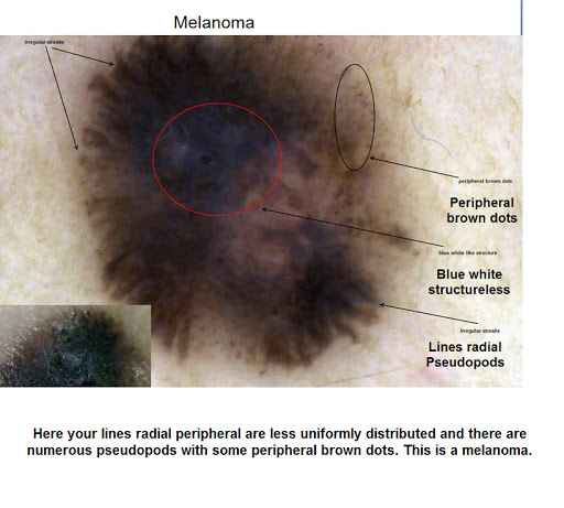 Dermoscopy Features as Clues: Lines radial peripheral or segmental ...