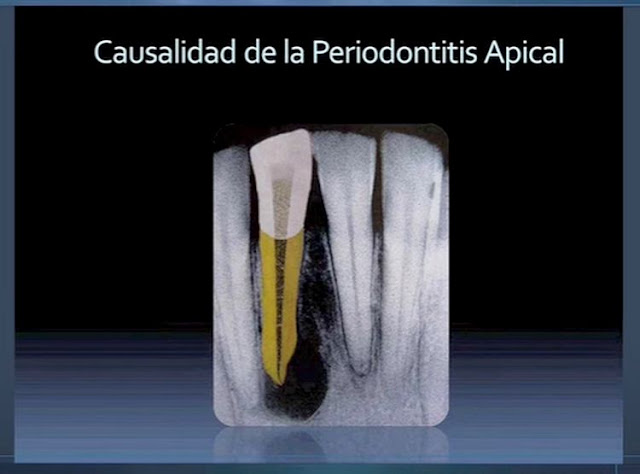 WEBINAR: Mecanismos de infección en ENDODONCIA - Dra. Tatiana Ramírez Mora