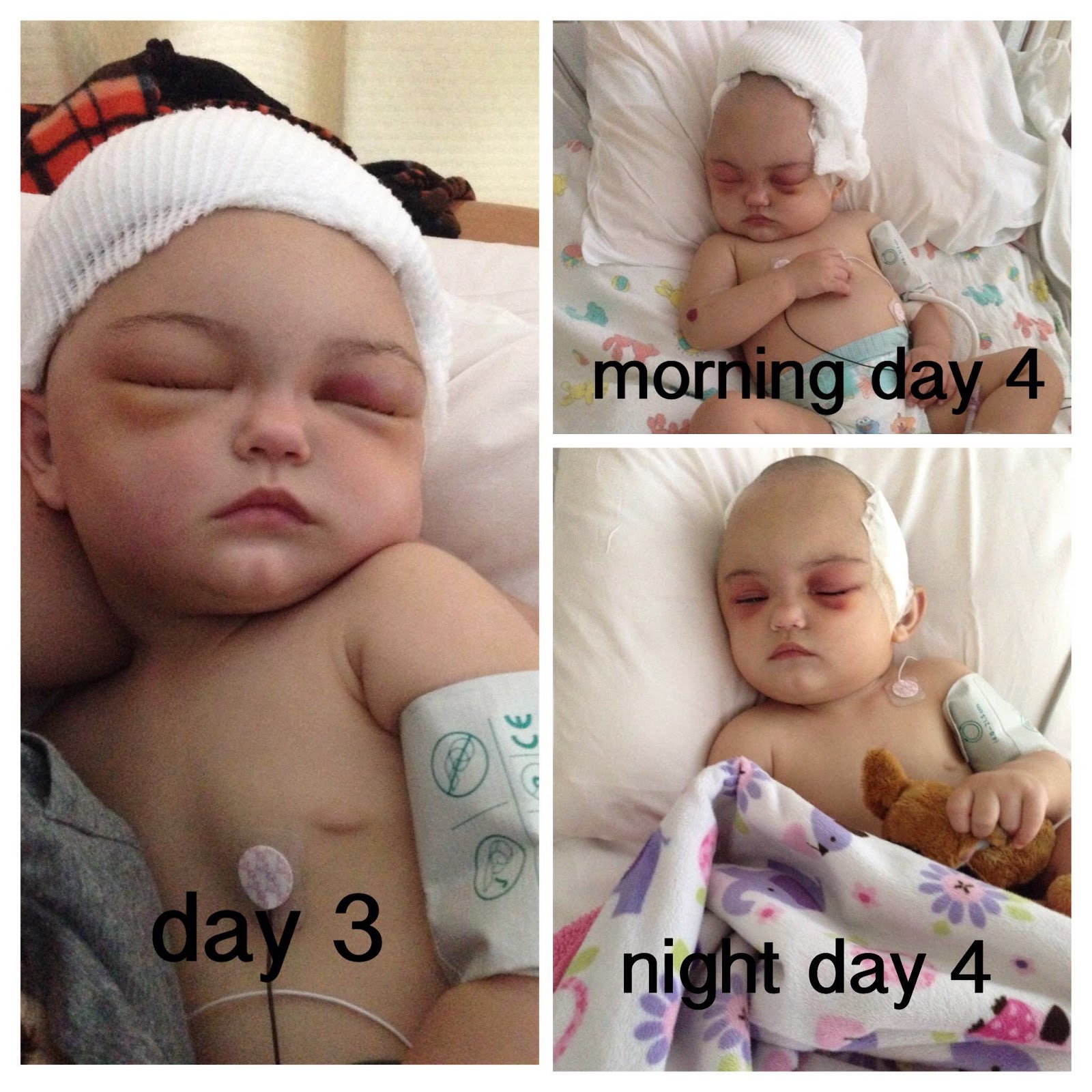 Rylen's Sagittal Cranial Vault Reconstruction Surgery Recap