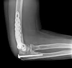 Medical Treatment Pictures-for Better Understanding: Elbow Replacement ...