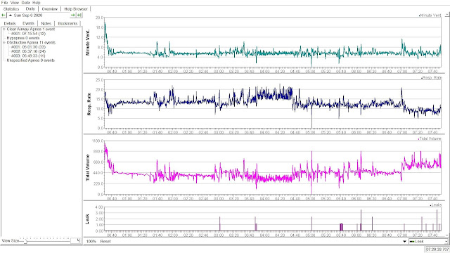 CPAP Health Issues: Use BiPAP to prevent Alzheimer's Dementia caused by ...