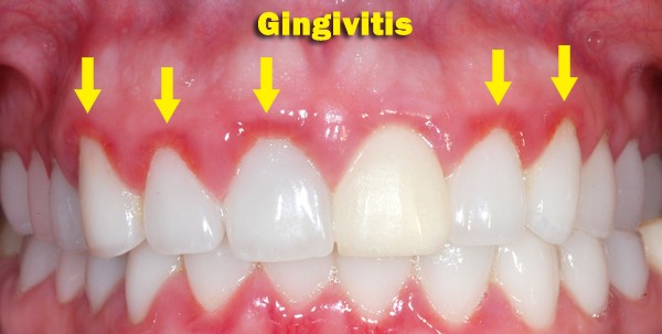 Kesehatan Gigi: GINGIVITIS