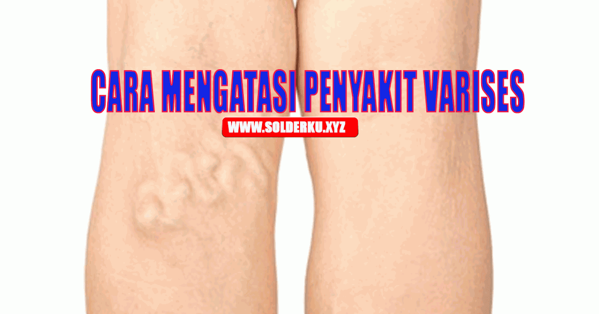 √Pengertian Varises, Penyebab Dan Cara Mengatasinya Secara Alami - solderku