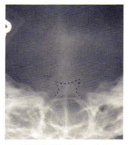 SILLA TURCA AXIAL AP (METODO DE TOWNE)