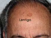 Dentistry and Medicine: Pigmented lesions of the head and neck