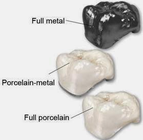Omni Dental Group: Crowns: An Overview