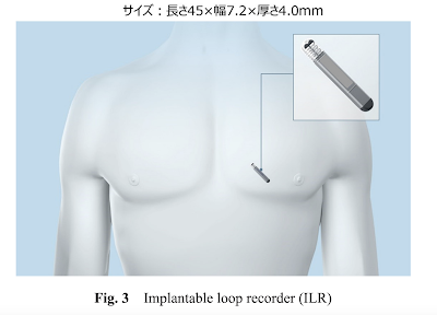 松下 ER ランチ・カンファレンス: 植込み型ループレコーダー Implantable loop recorder: ILR