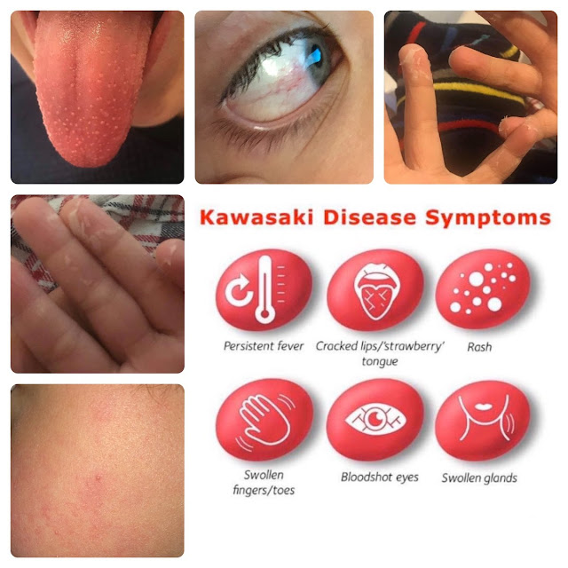 KAWASAKI DISEASE: CLINICAL GUIDELINES
