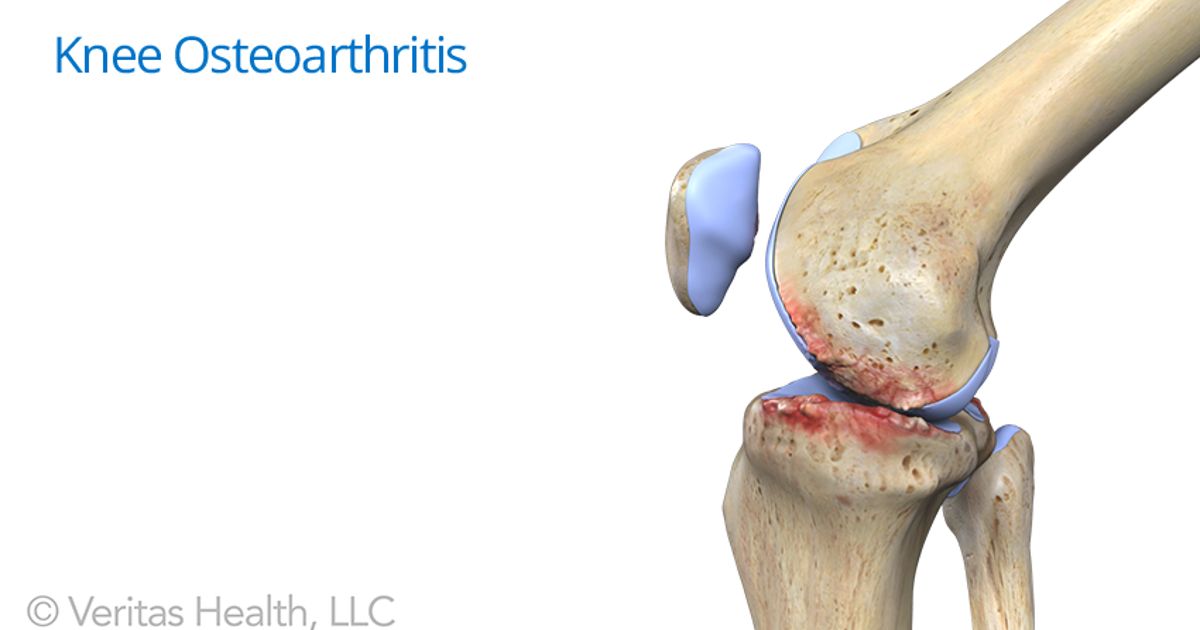 ERGONOMICS GUIDE: CHRONIC KNEE PAIN