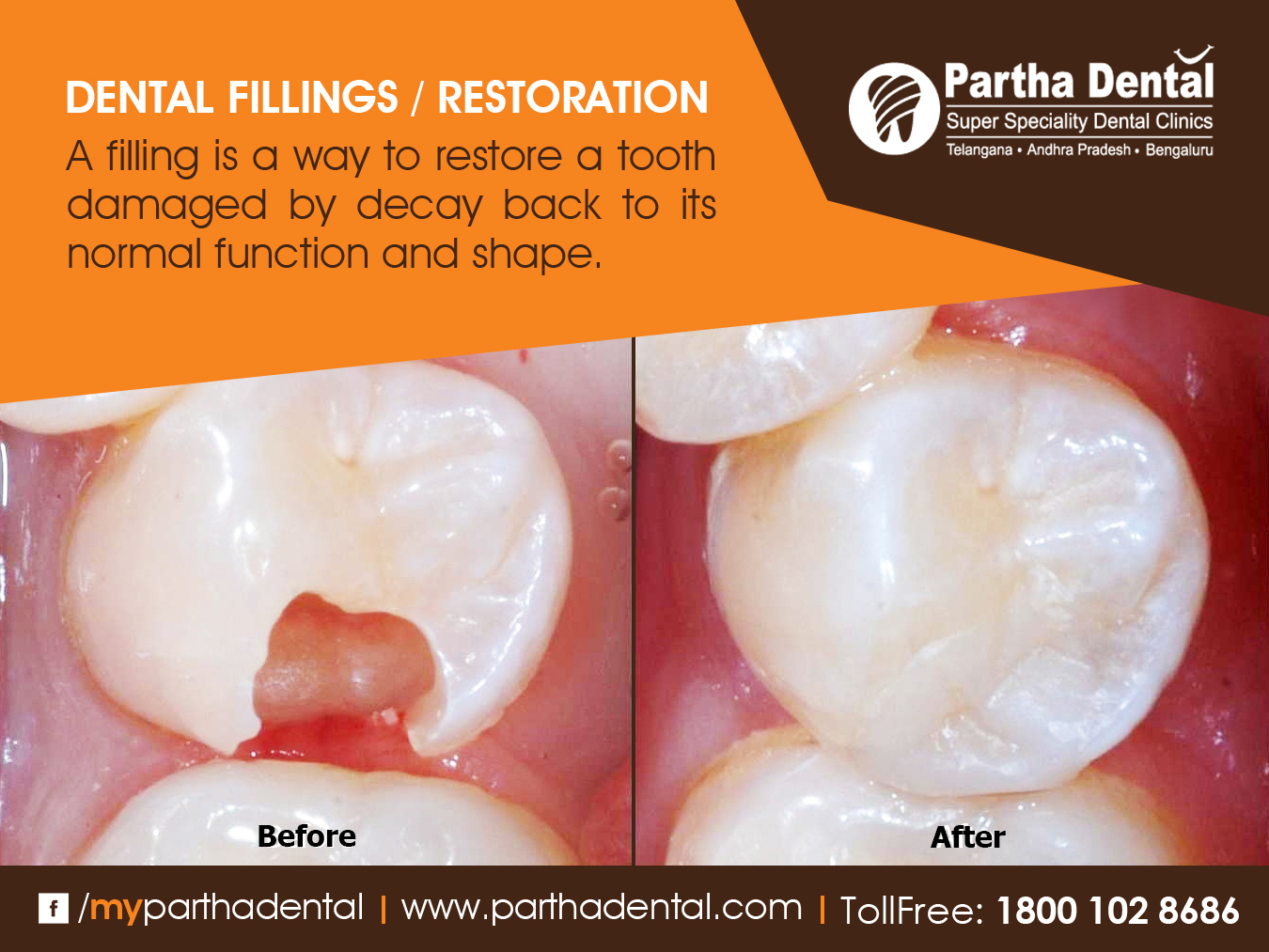 Dental filling is a way to restore a tooth damaged by decay back to its ...