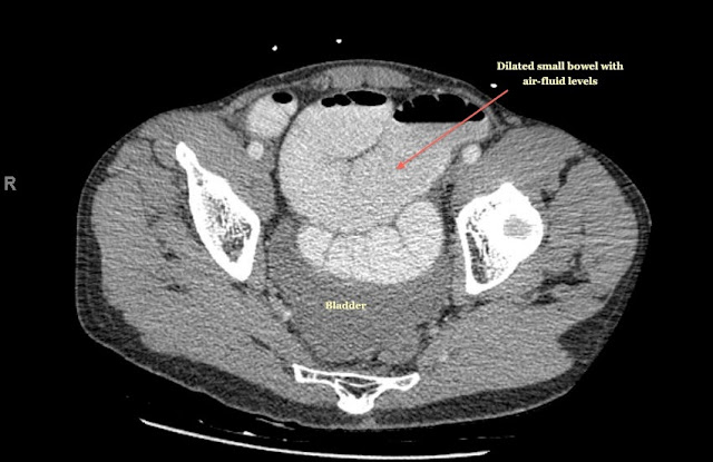 Small Bowel Obstruction ~ Ultrasound Cases Info