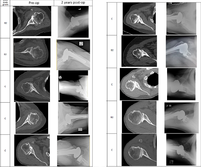 Shoulder Arthritis / Rotator Cuff Tears / Shoulder Pain : Glenoid ...