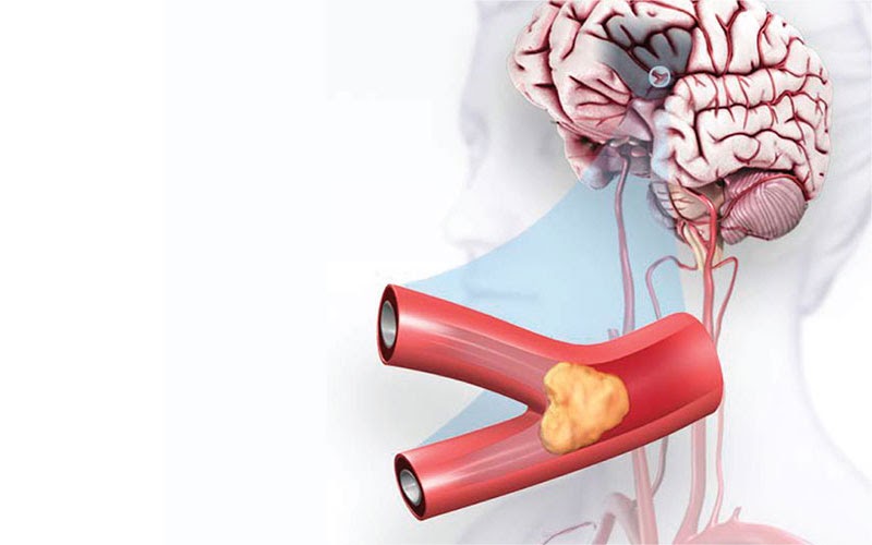 ພະຍາດເສັ້ນເລືອດສະໝອງ Cerebrovascular Disease “stroke”