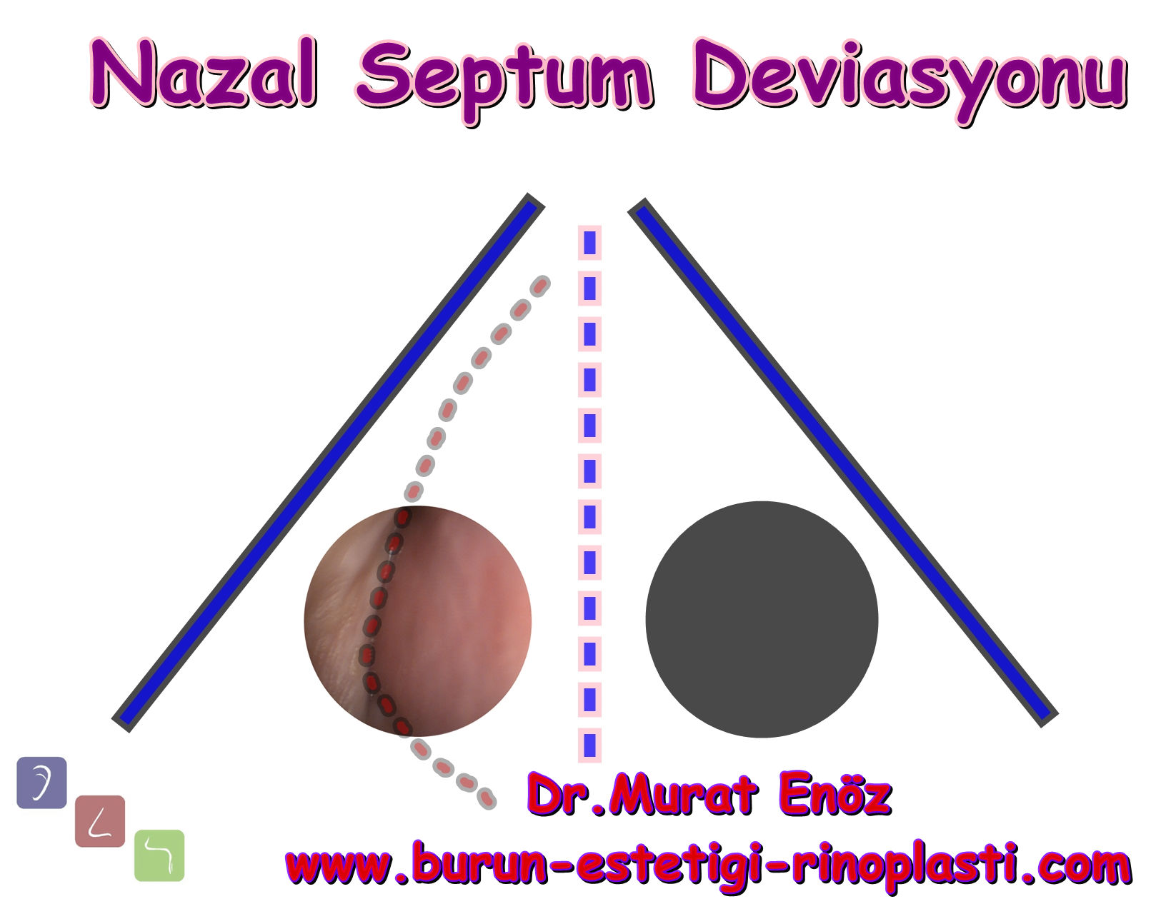 Health Zone Turkey: What is The "Nasal Septum Deviation" and ...