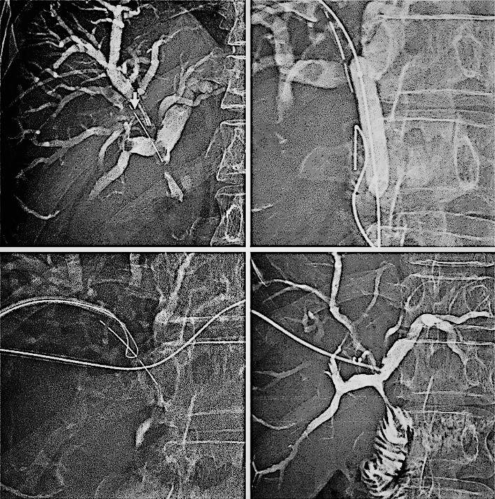Percutaneous Transhepatic Cholangiography ( PTC )