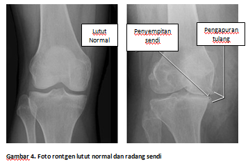 KLINIK ONLINE BEDAH ORTHOPAEDI: Nyeri Sendi Lutut (Osteoarthritis) part ...