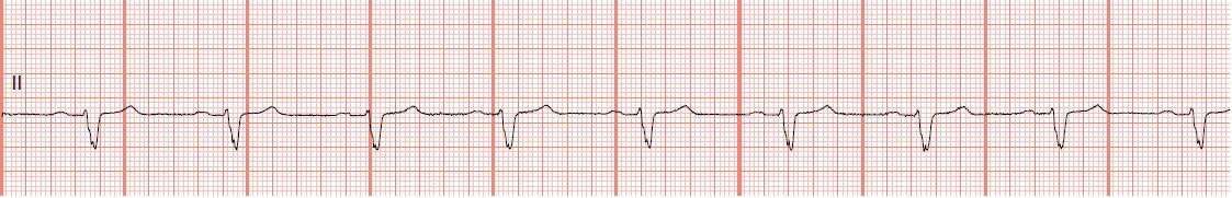 EKG Rhythm Strip Quiz 52: Heart Blocks