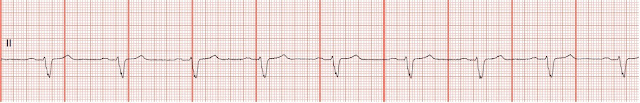 Float Nurse: EKG Rhythm Strip Quiz 52: Heart Blocks