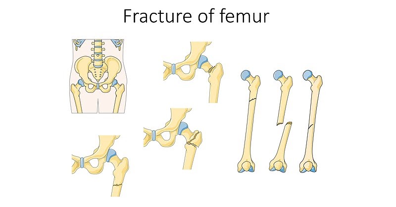 Femur Fracture Treatment | Femur Bone Fracture Surgery