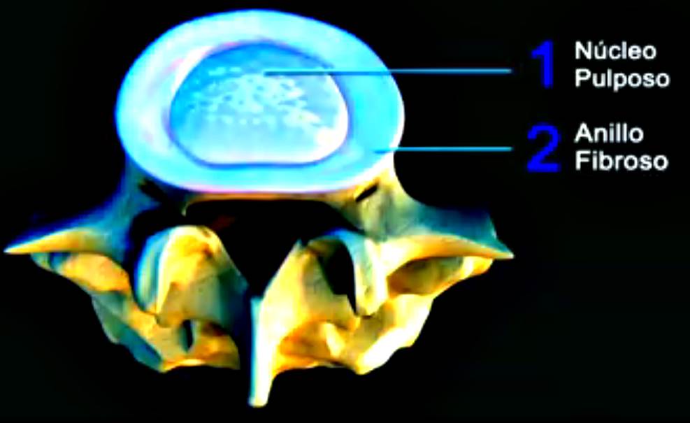 La hernia de disco intervertebral se puede curar con Ozonoterapia, no ...