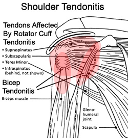 Shoulder Tendonitis
