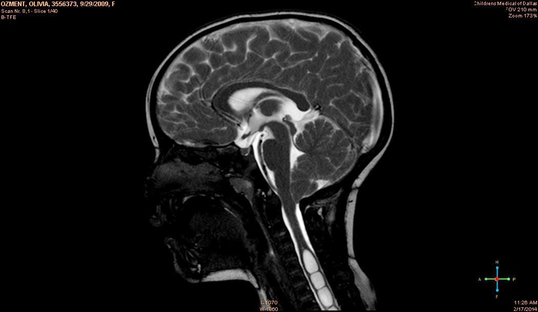 Children's Chiari Journal: CSF Flow Study part 1