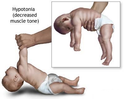 Pediatrics Notes: Causes Of Hypotonia In The Newborn