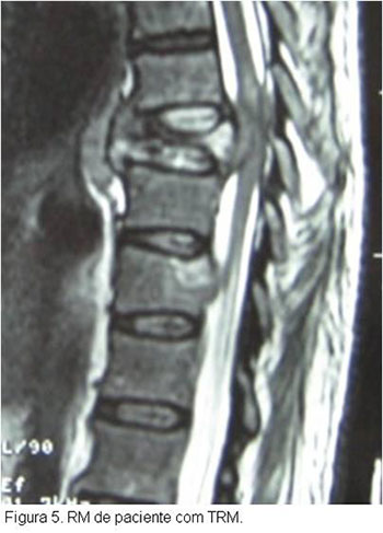 TRAUMATISMO RAQUIMEDULAR