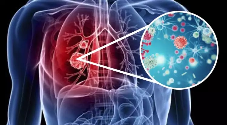 Tuberculosis (TB): Causes, Symptoms, and Treatments: BizGlob