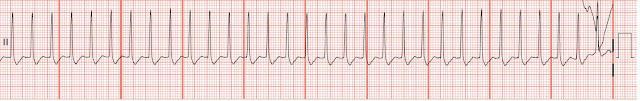 EKG Rhythm Strips 33