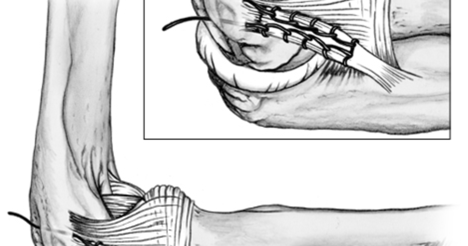 Shoulder and Elbow Surgery: Terrible triad injury. The importance of ...