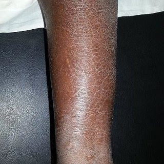 LA XÉROSE OU LA SÉCHERESSE DE LA PEAU - Africa Green Magazine