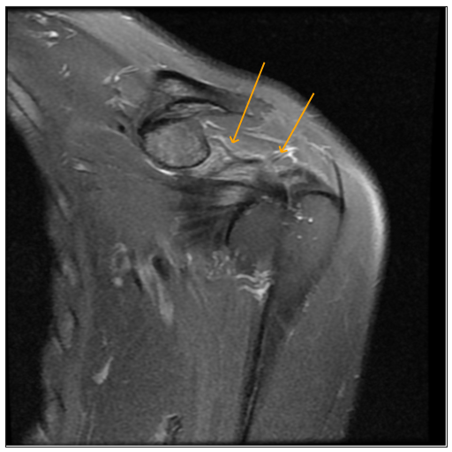 Adhesive Capsulitis : MRI - Sumer's Radiology Blog